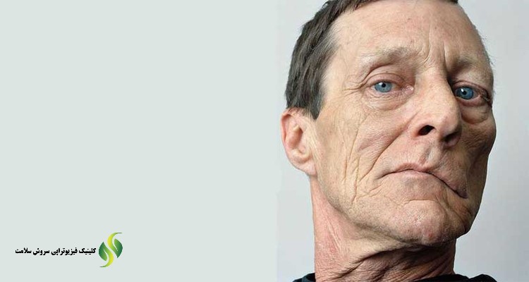 فلج بل چیست؛ بررسی علائم و روش تشخیص